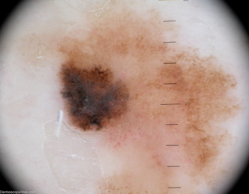 News — Dermtest: Muttermal-check direkt von Experten